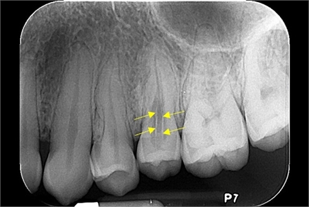 Early detection of external invasive cervical root resorption